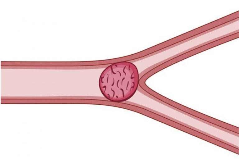 Prostat Arter Embolizasyonu | Prostat Ameliyatı